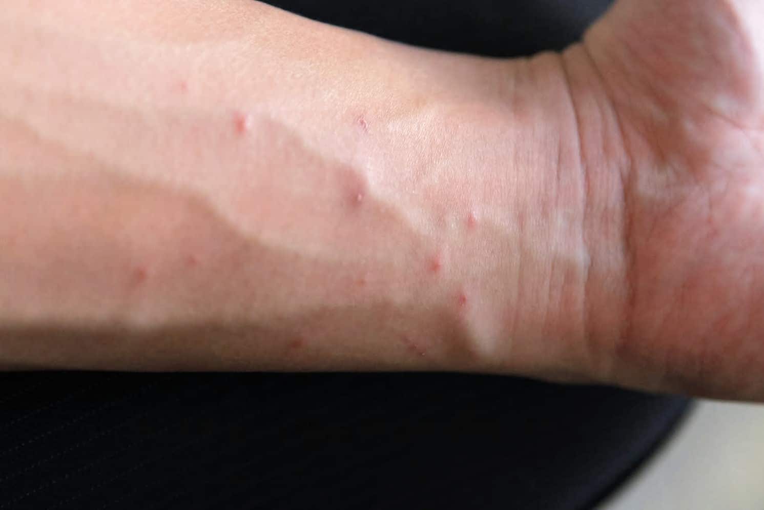 Itching And Rash After Scabies Treatment At Jean Humphrey Blog